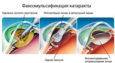 Восстановление зрения и лечение перезрелой катаракты